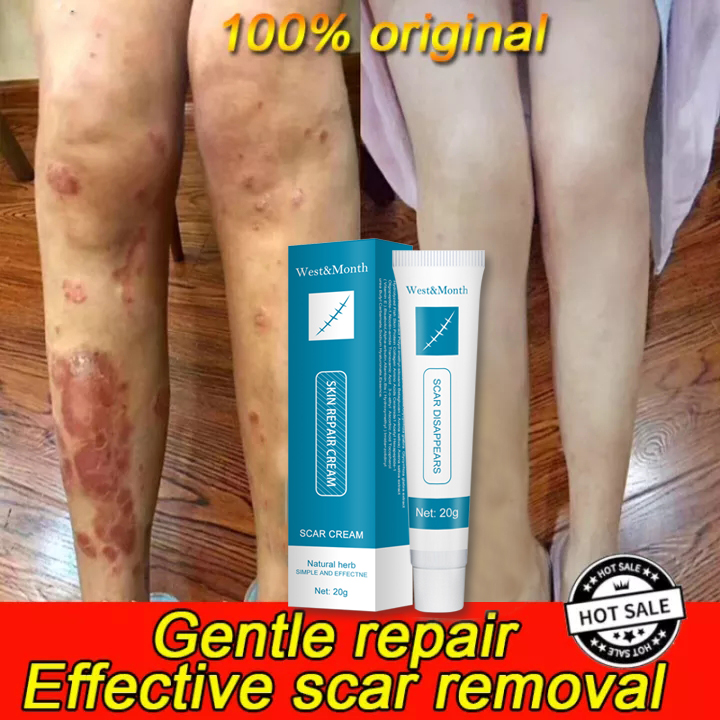 Scar Remover Cream New and old scars on the body Remove traces nourish ...
