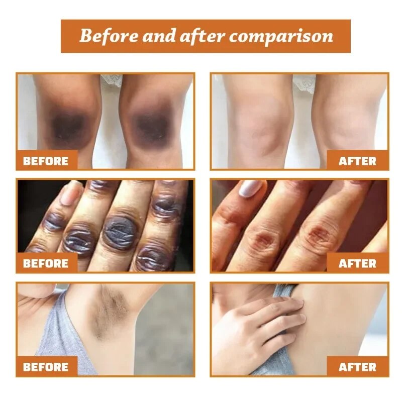 TAHANgTA Hot Selling Removal Dark Melanin Essence Finger Joints Brightening thigh inner Knee ...