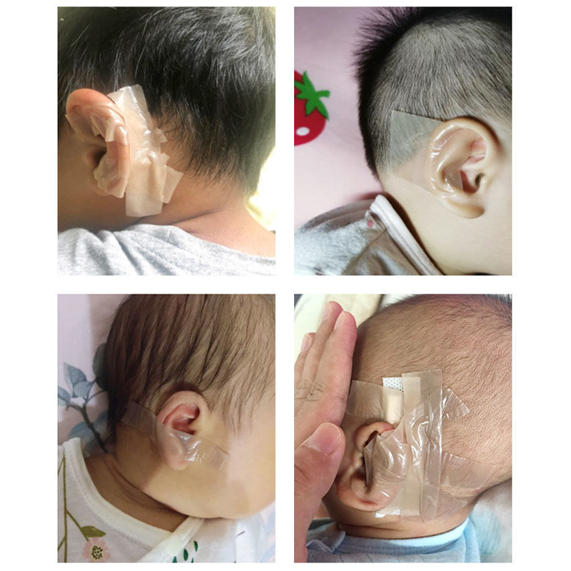 Baby Ear Correctors Medical Silicone Tape Infant Ear Correction Patch ...