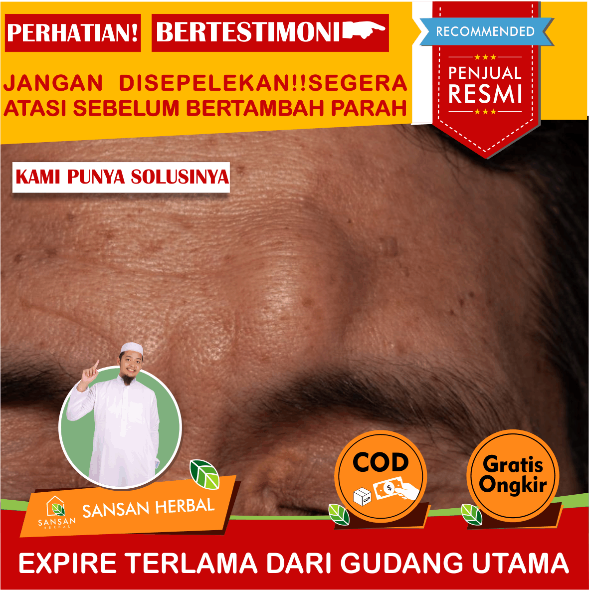 Obat Benjolan di Wajah, Obat Menghilangkan Benjolan di Wajah, Obat ...