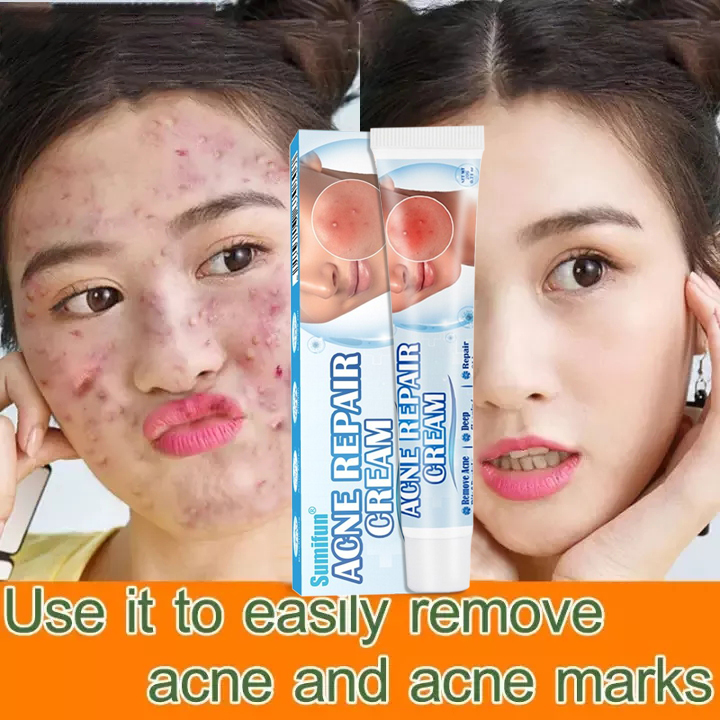 Original Acne cream Acne gel Acne remover Pimple remover anti-bacterial ...