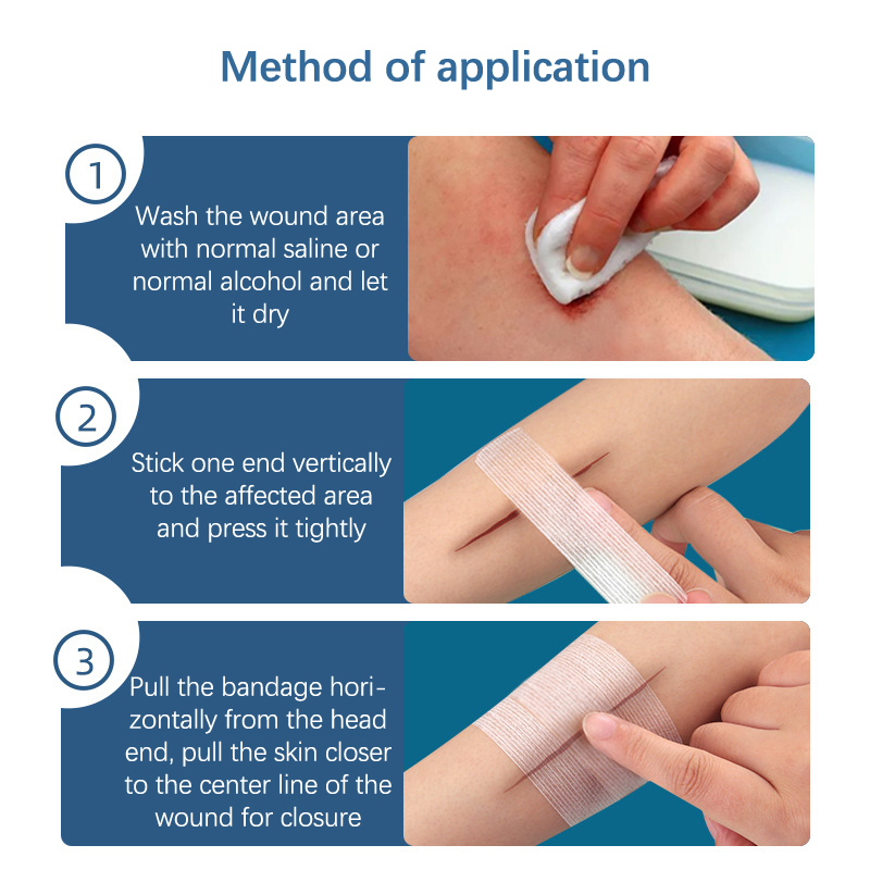 【SmartHorizon】Wound Skin Closure Strips Postpartum Wound Repair ...