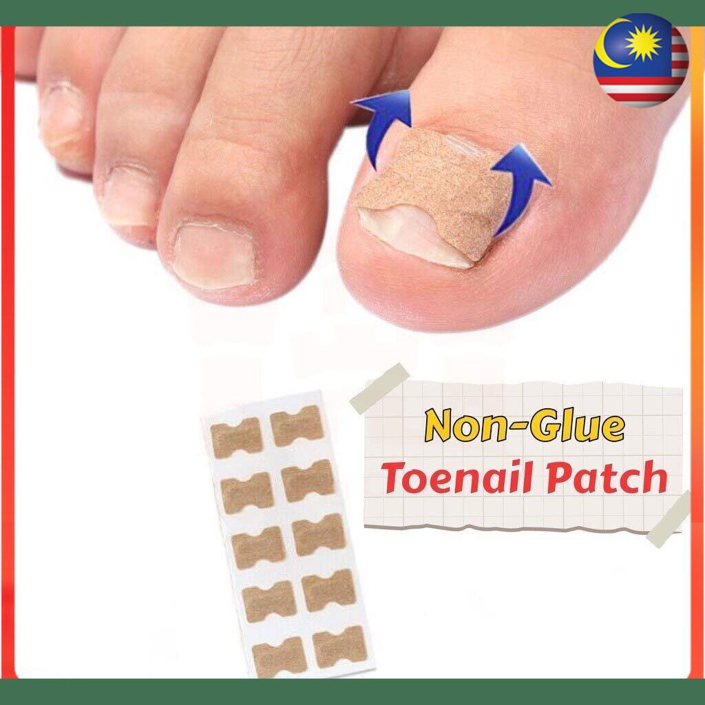 Caring Castle Non-Glue Toenail Patch Ingrown Correction paronychia ...