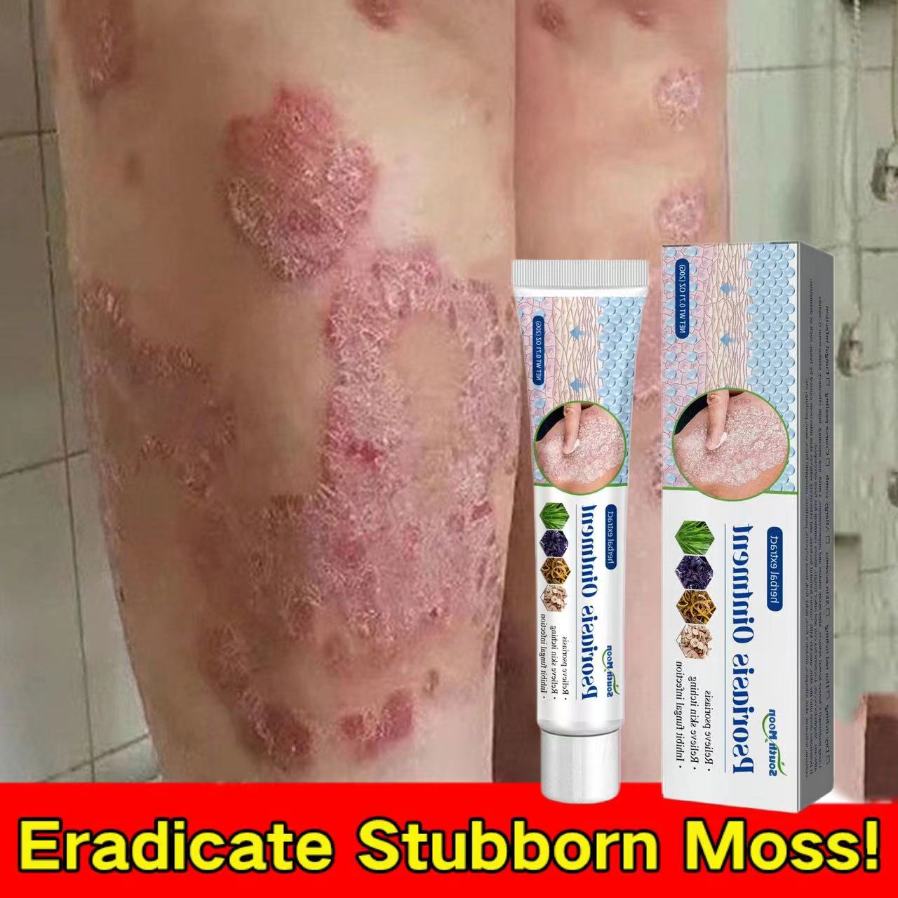 South Moon Atoderma Cream Original Gamot sa kati kati sa balat ointment ...