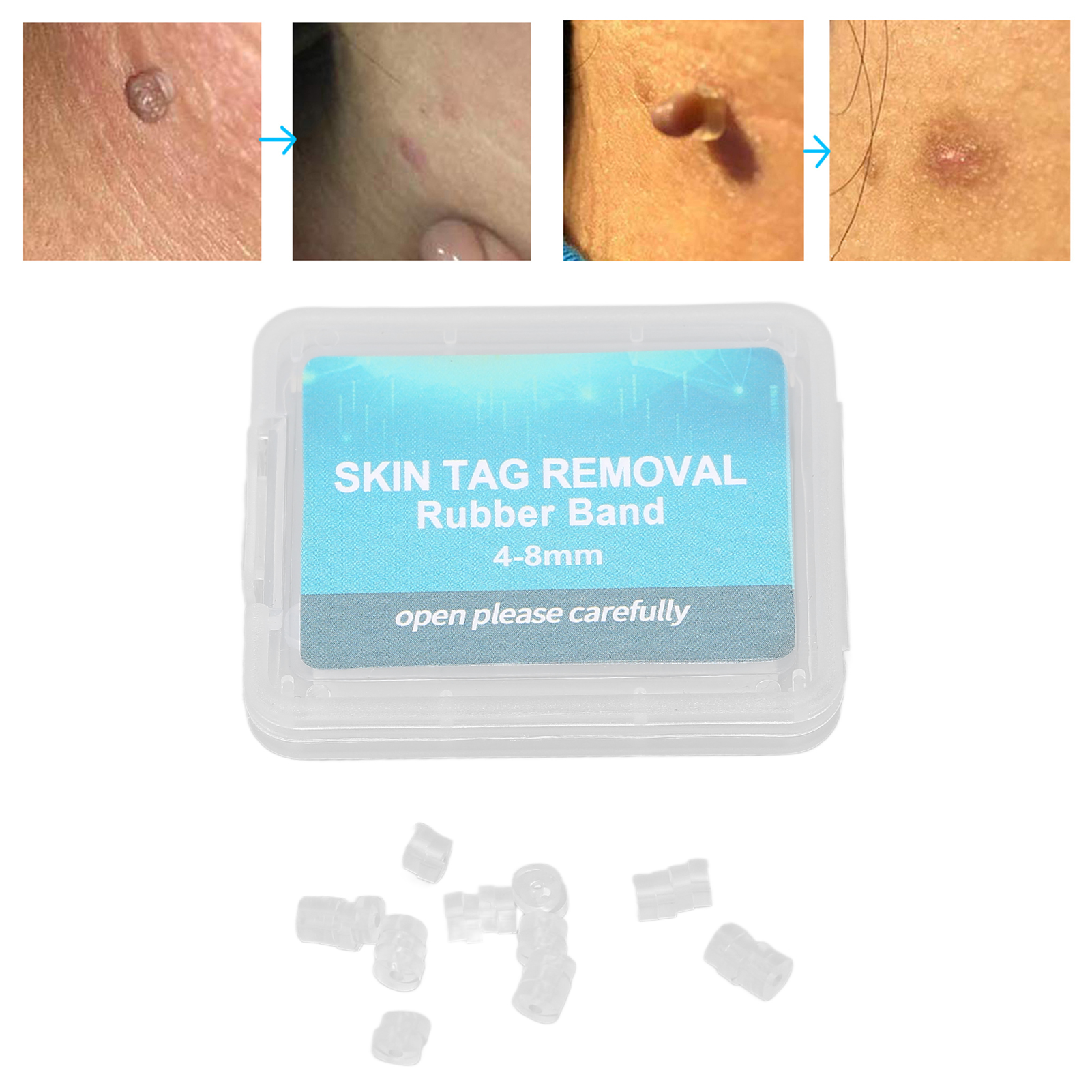30pcs Face Care Skin Tag Rubber Bands Beauty Health Mole Wart Removal ...
