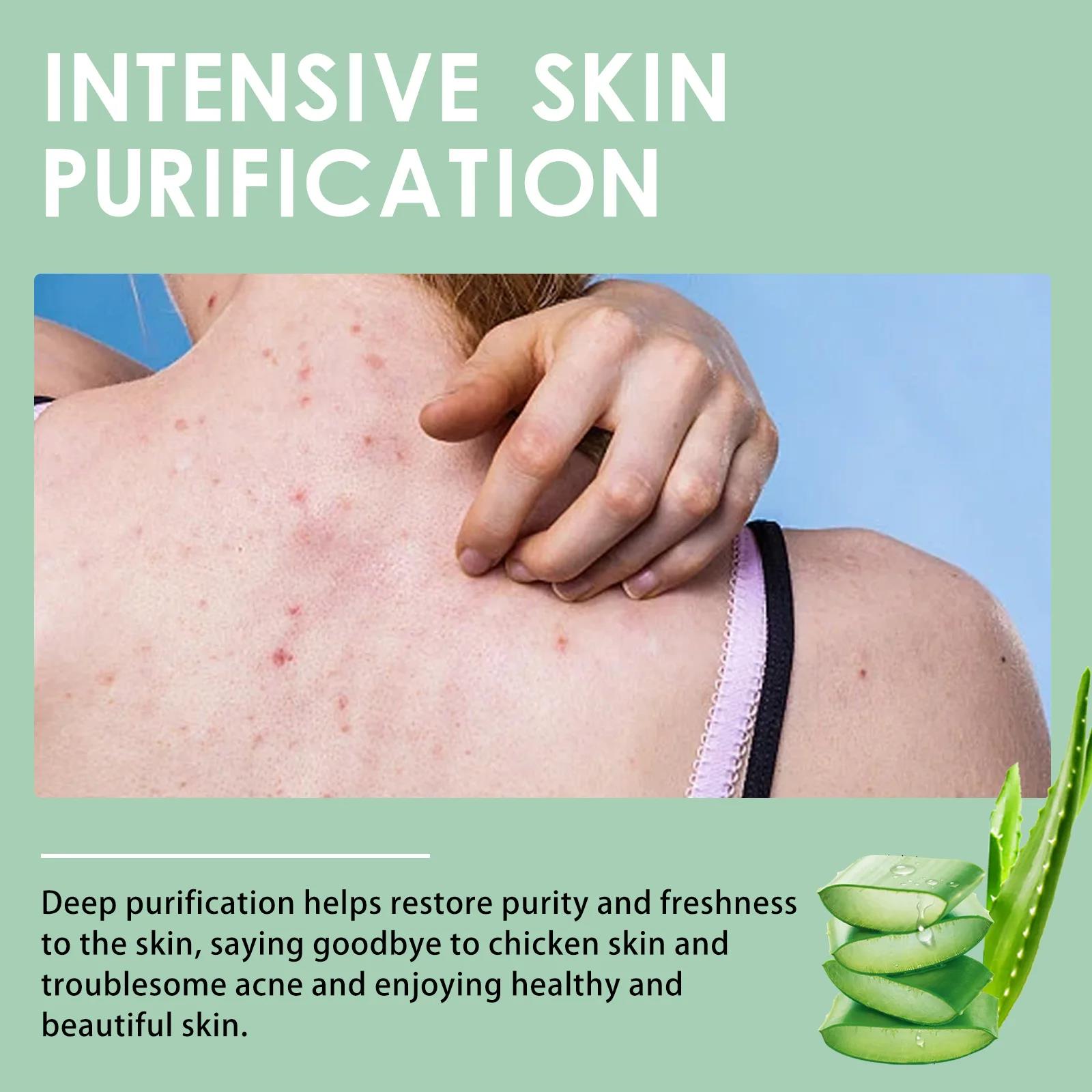 Keratosis Pilaris Repair Cream Cleaning Acne Spots Remove Follicle ...